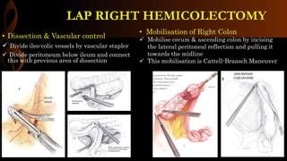 Lap Right Hemicolectomy Step By Step Operative Surgerypptx