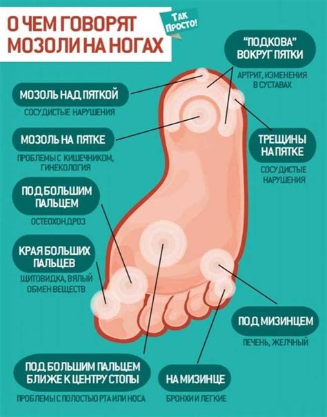 О чем говорят мозоли на ногах | САМОДИАГНОСТИКА ОРГАНИЗМА | Постила