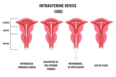 Premium Vector Intrauterine Device Iud Infographic In Vector