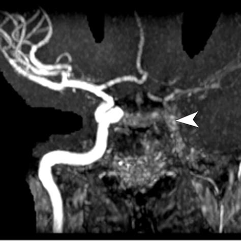 Vasculitis In The Emergency Room The Pivotal Role Of Imaging In