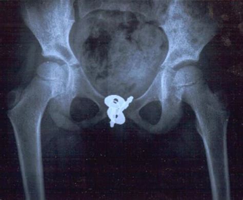 Vaginal Insert Bedsand