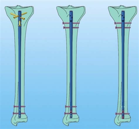 Titanium Intramedullary Nail System Proximal Tibial Interlocking Nail