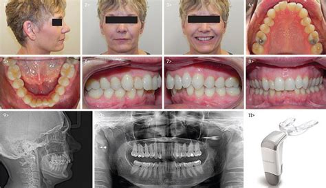Class Ii Div I Occlusion Venessa Mcnabb