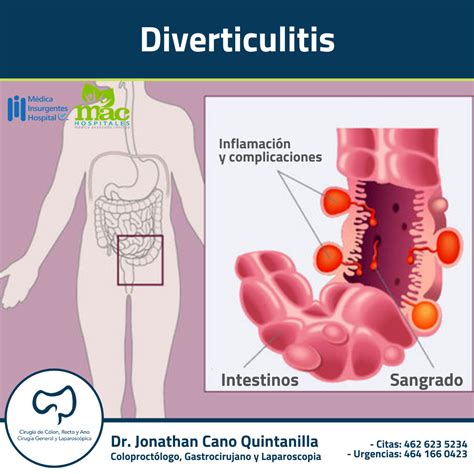 Dr Jonathan Cano Coloproctólogo Gastrocirujano Laparoscopia La