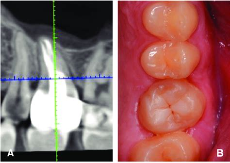 A Cbct Scans After 30 Months Postsurgery B Condition Of Soft Tissue Download Scientific