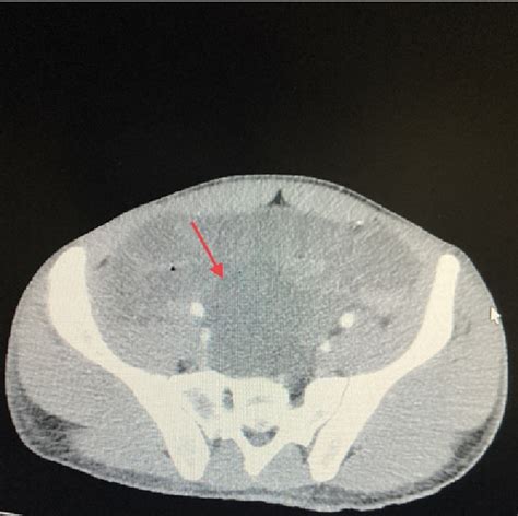 The View Of Cyst In Ct Download Scientific Diagram