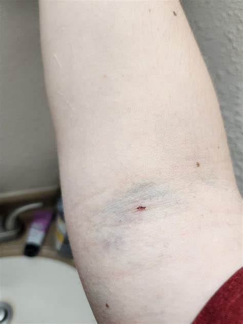 Approx 48 Hour Progression Of A Hematoma From A Plasma Donation Gone Wrong R Medizzy