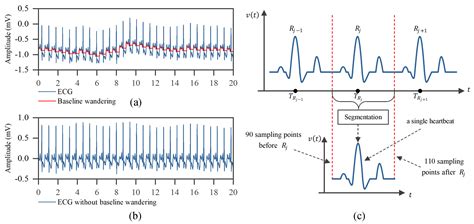 Automatic Ecg Classification Using Continuous Wavelet Transform And Convolutional Neural Network