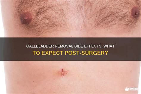 Gallbladder Removal Side Effects What To Expect Post Surgery Medshun
