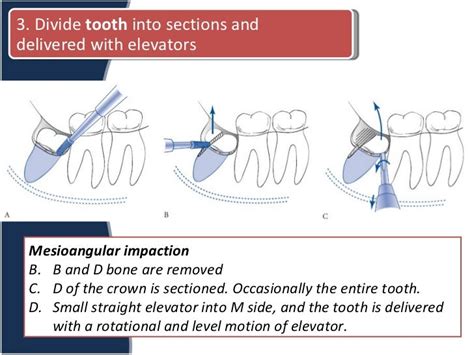 Complicated Extraction And Odontectomy
