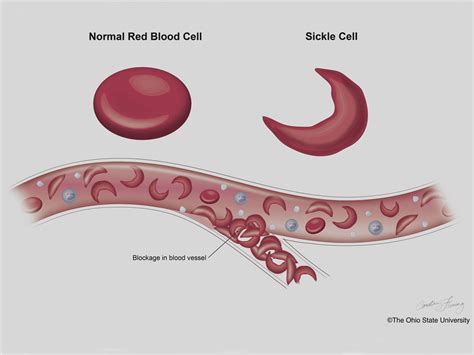 Sickle Cell Coloring Pages [2025]