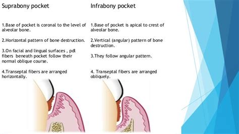 Periodontal Pocket