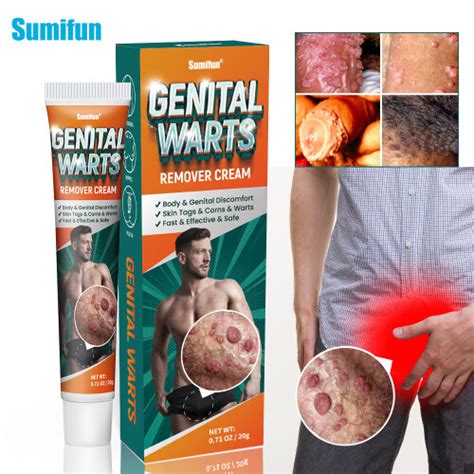 Genital Wart Removal Cream For Men Private Care 20g Safe And Gentle