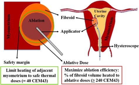 Uterus Anatomy And Treatment Objectives Of Proposed Transcervical Download Scientific Diagram