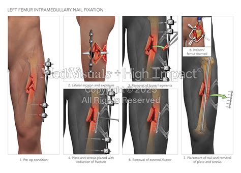 Left Femur Intramedullary Nail Fixation
