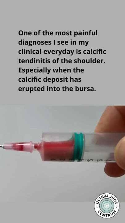 Jens Lundgren On Linkedin Shoulder Calcification Ultrasound