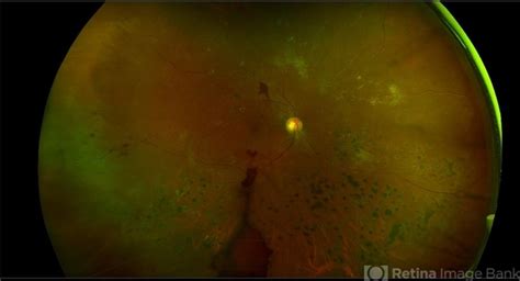 Proliferative Diabetic Retinopathy With Vitreous Hemorrhage Retina