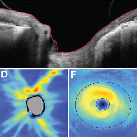 Rnfl Thickness More Useful Than Minimum Rim Width Early In Glaucoma