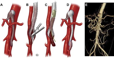 Mesenteric Artery Disease Drsrujal Shah