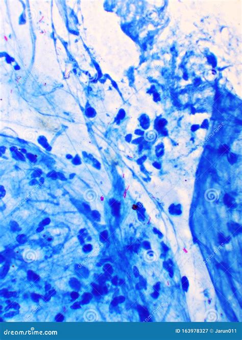 Mycobacterium Tuberculosis Positive In Sputum Smear Stock Image Image Of Laboratory
