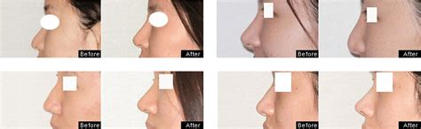 Nose Shapes Types Learn About Different Nose Shapes Sedgh Plastic