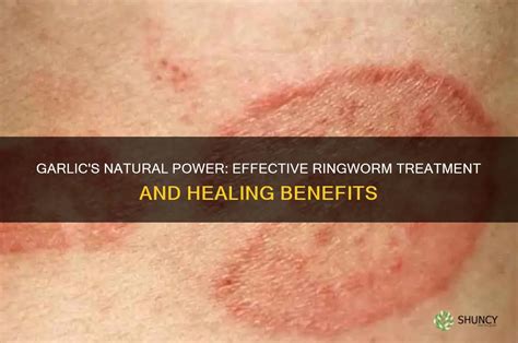 Garlics Natural Power Effective Ringworm Treatment And Healing Benefits Shuncy