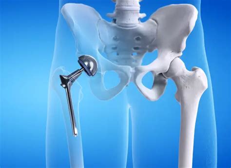 Total Hip Joint Replacement Types Procedure Benefits And Risks