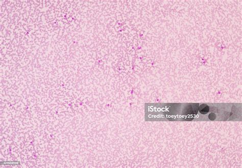 Neutrofilia Adalah Leukositosis Neutrofil Itu Num Tinggi Foto Stok
