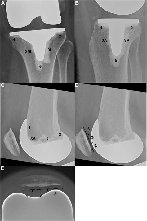 Medialized Dome And Anatomic Onlay Patella Designs In The Modern