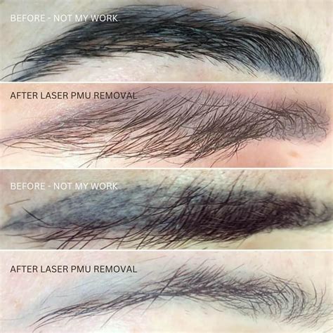 Permanent Makeup Removal And Correction In Bexhill East Sussex Before