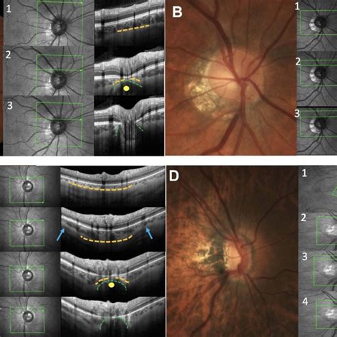 Subarachnoid Space Visibility Peripapillary Intrachoroidal Cavitation Download Scientific
