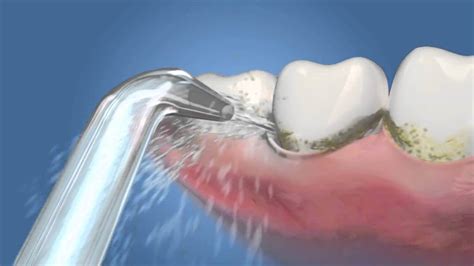 Water Flossing With The Water Pik Colorado Springs Dentist