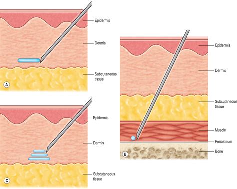 Injectables And Resurfacing Techniques Soft Tissue Fillers Clinical Tree