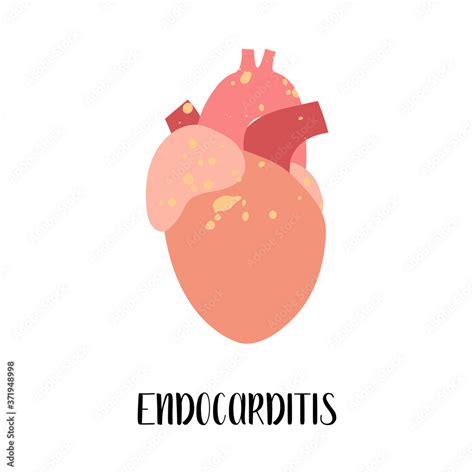 Endocarditis Heart Cardiovascular Disease Cardiology Vector Flat Illustration For Flyer