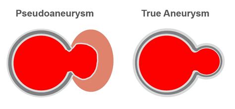 Pseudoaneurysm Vs Aneurysm