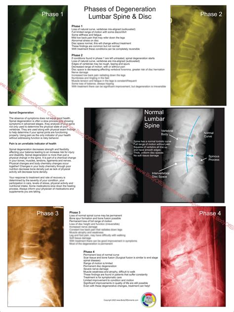 Lumbar Spinal Degeneration Phases Poster Body Of Elements