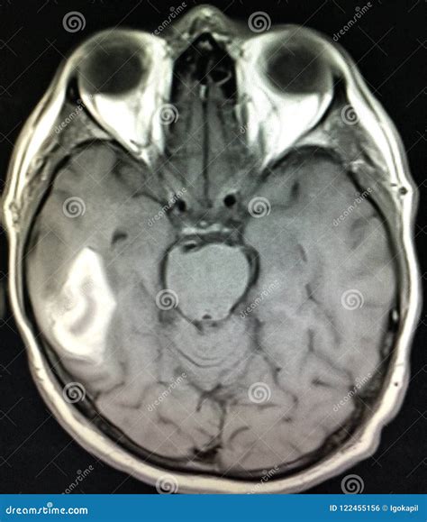 Intraparenchymal Hematoma Brain Pathology Mri Royalty Free Stock Image