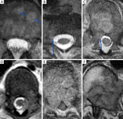 Escc Classification Depicted By T2 Weighted Mri Escc Grade 0 A