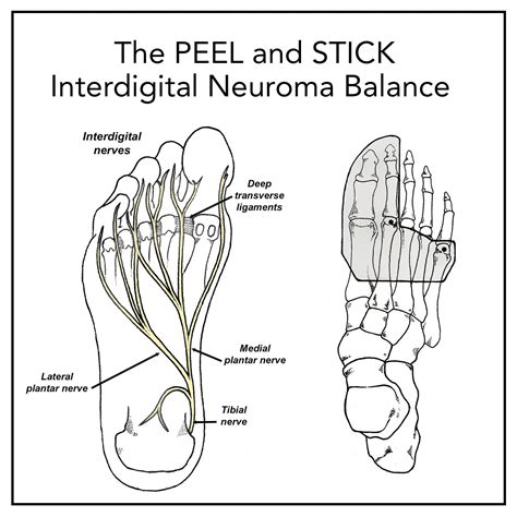 Peel And Stick Balances The Interdigital Neuroma Balance Human