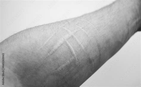 Scars From Cuts On The Arm Old Traces Of A Skin Cut On The Forearm