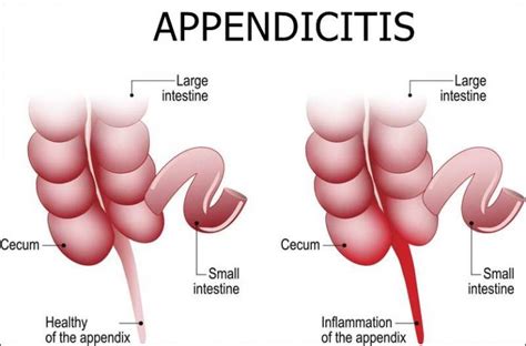 What Side Is Your Appendix On Appendicitis Symptoms Treatments