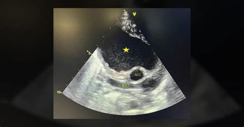 Paediatric Case Study Aortic Pseudoaneurysm After Ventricular Septal