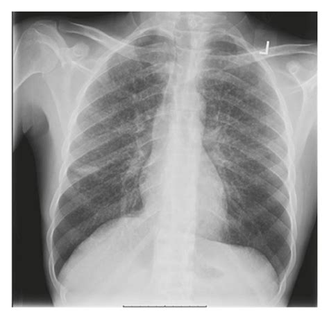 A Chest Radiograph Showing Diffuse Micronodules B Axial View Of Download Scientific