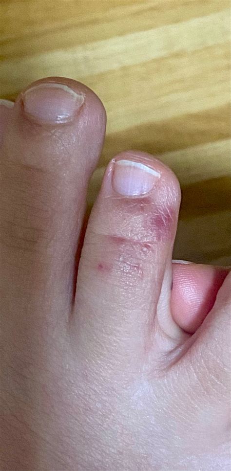 발가락 가려움 따가움 발진 멍 지식in