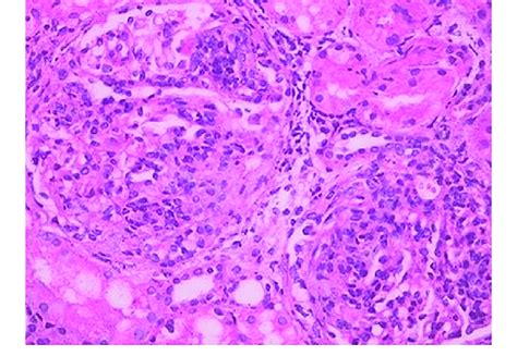 Renal Biopsy Showing Lupus Nephritis Glomeruli With Diffuse Mesangial Download Scientific