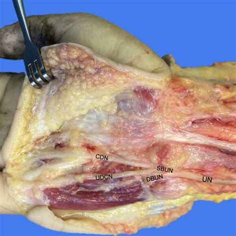 Course Of The Ulnar Nerve In The Wrist At The Level Of The Ulnar