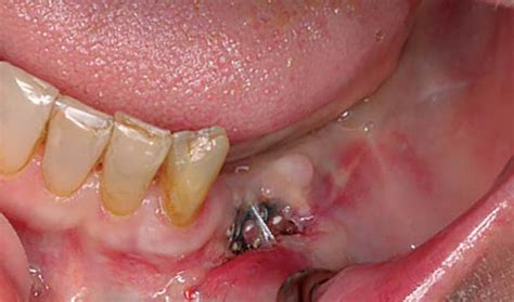 Vertical Defect In The Posterior Mandible 4 Teeth Gap Geistlich