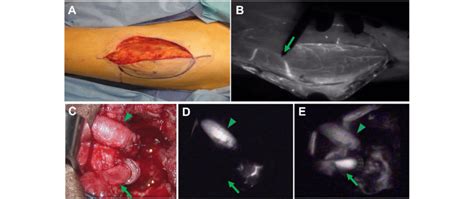 Icg Angiography In Microvascular Reconstructive Surgery A Download Scientific Diagram