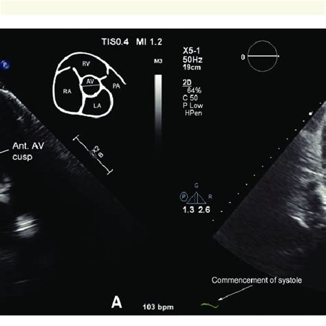 Transition Steps From Ecmo To Protek Duo® Ecmo Extracorporeal Membrane Download Scientific