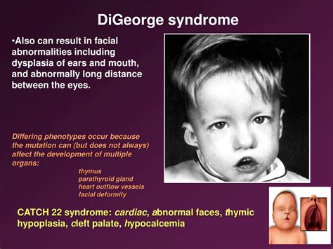 Ppt Immunodeficiencies Digeorge Syndrome And Thymic Defects Powerpoint